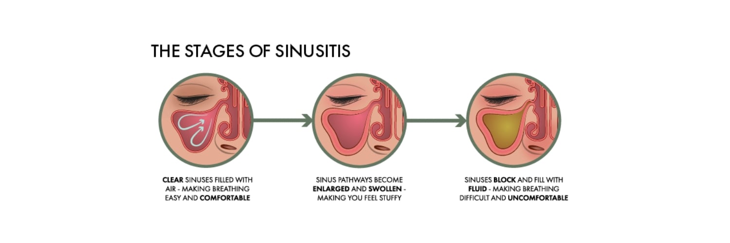 How To Sleep With Sinusitis Sinusitis and Sleep Woolroom